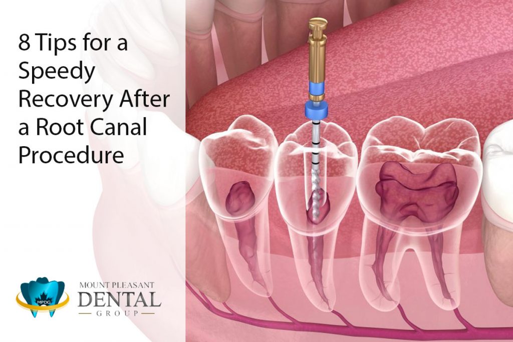 8 Tips for a Speedy Recovery After a Root Canal Procedure - Mount ...